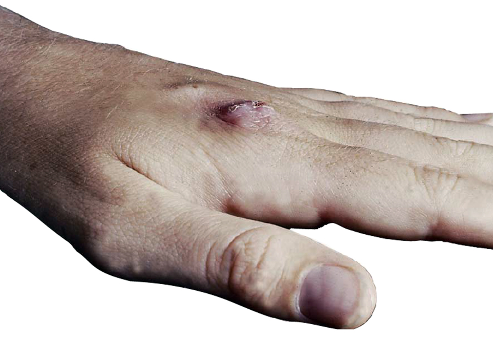 Seafood-associated mycobacterial infections - Responsible Seafood Advocate